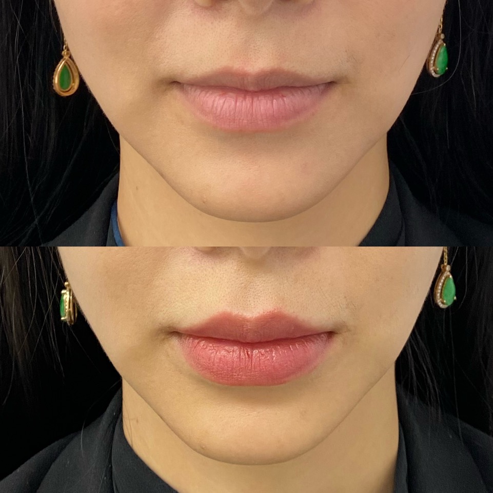 Enhancing The Natural Beauty Of Your Lips: 5 Must-Ask Questions Before ...