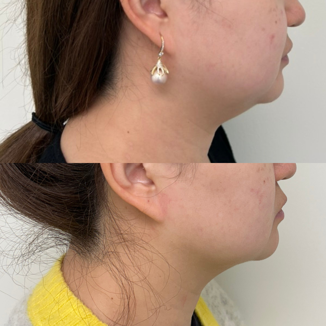 Breaking down the facts about Lipodissolve - Debut Aesthetics