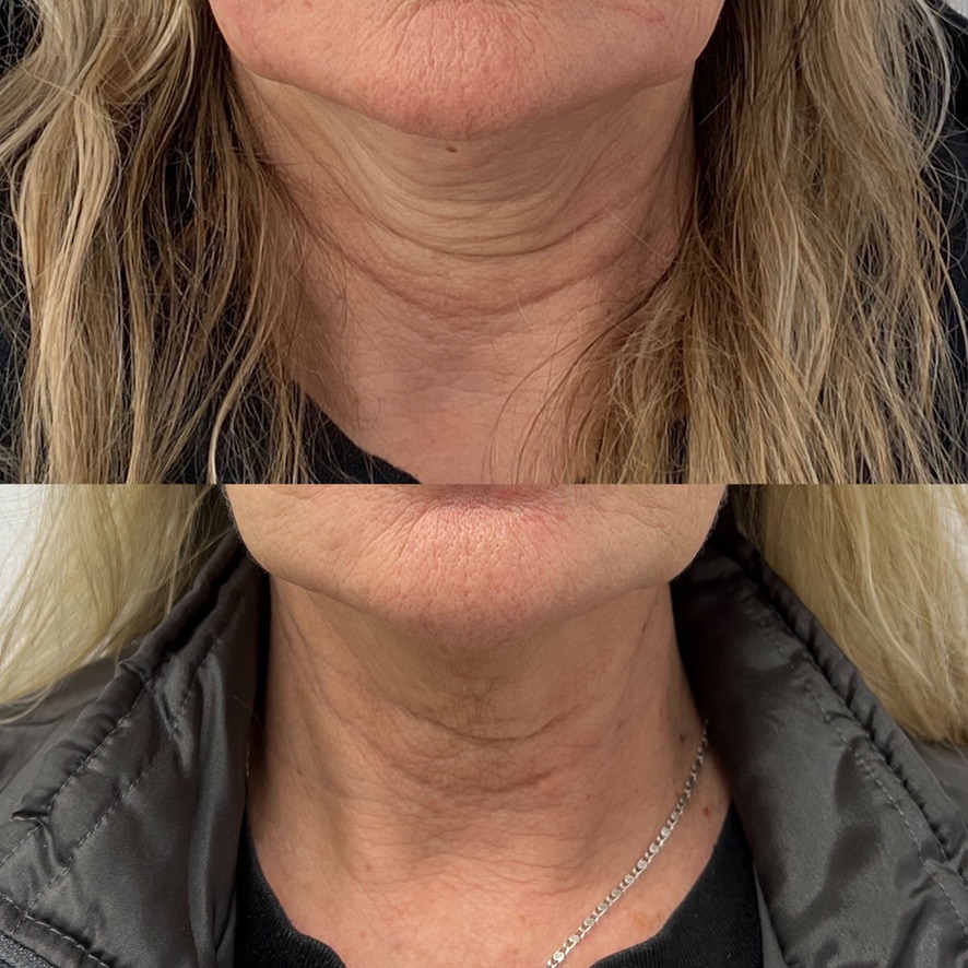 The Ultimate Boost with Biostimulator Injectable Treatments - Debut ...